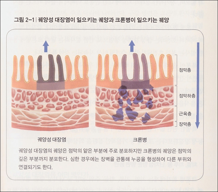 도서후기 튼튼한 장 건강한 밥상 크론병 궤양성대장염 네이버 블로그