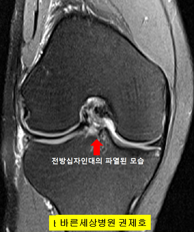 전방 십자인대 파열 회사에서 족구하는 중에 무릎에서 뚝 전방 십자인대 재건술 타가건 서울바른세상병원 권제호 네이버 블로그