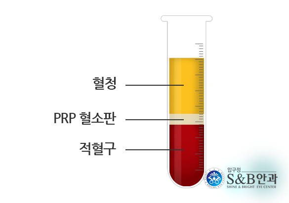 자가혈청prp란 압구정 에스앤비안과 네이버 블로그