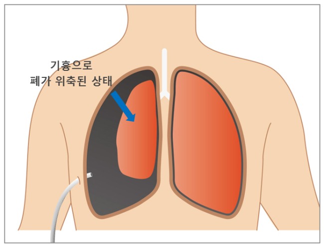기흉치료기흉수술 후기 네이버 블로그