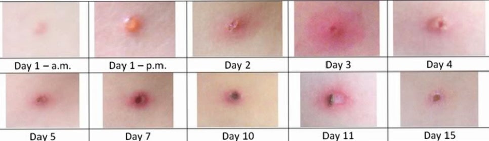 수두 초기증상과 잠복기 And 치료와 예방법 한번에 정리 네이버 블로그