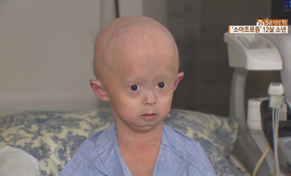 우리나라 단 1명 소아 조로증 앓는 아이 원기 하단 이미지를 누른 뒤 사연을 페이 네이버 포스트