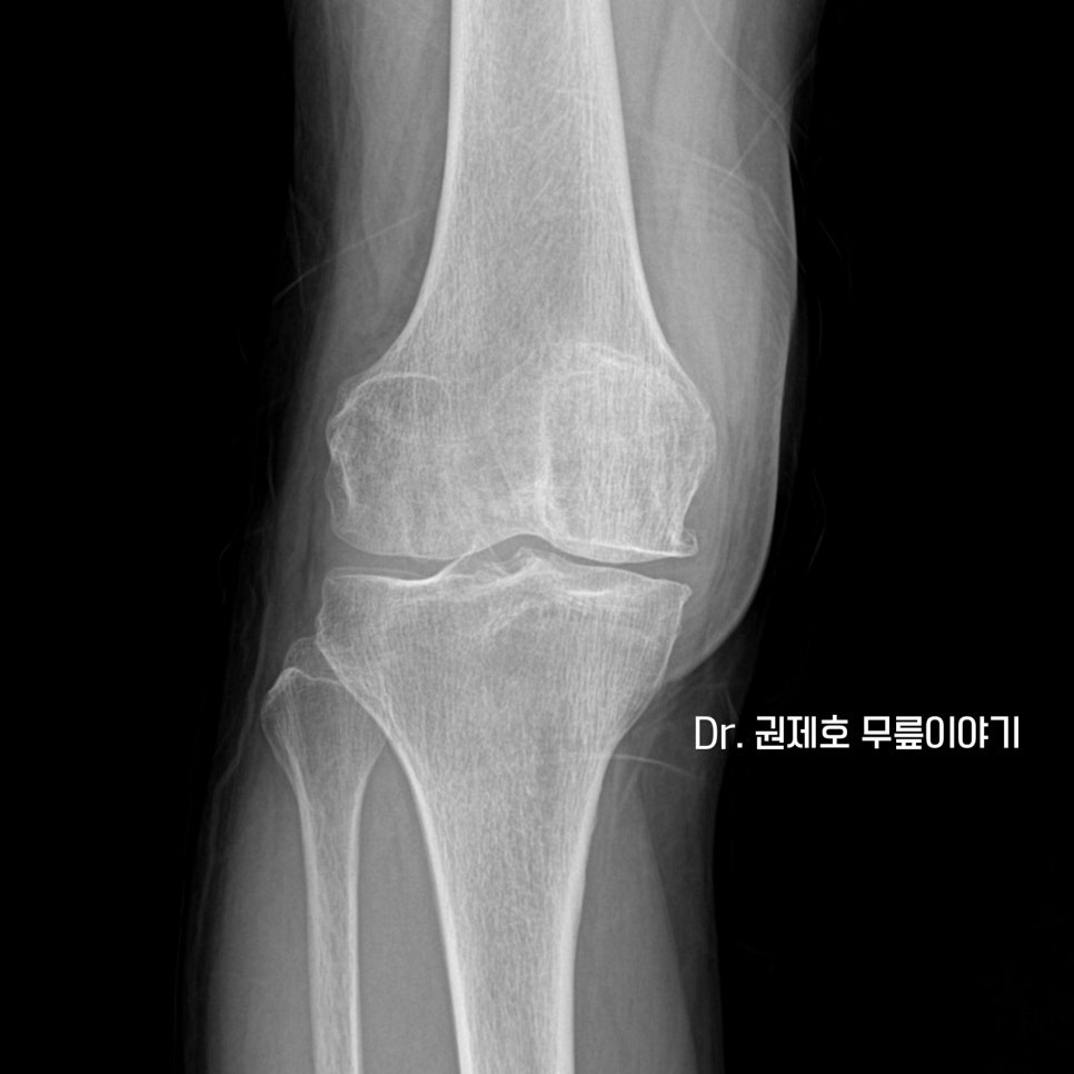 무릎슬개골골절 와이어를 이용한 Figure 8자 고정술 네이버 블로그