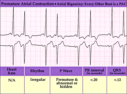 EKG Cardiac rhythm diagnosis : 네이버 블로그