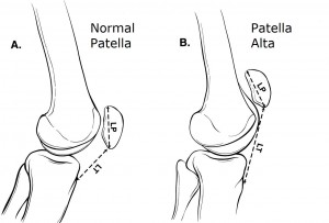 무릎 관절 기본 해부학 + 슬개골/무릎뼈의 부정렬 (Patellar alta, Lateral tracking, squinting ...