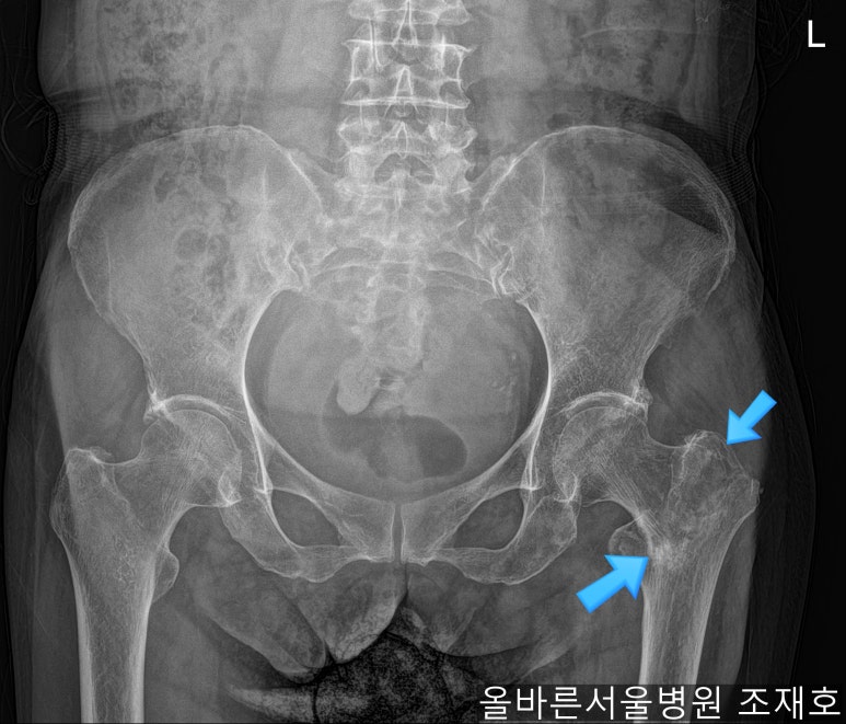대퇴 전자간부 골절에서의 대퇴 근위 골수강내정 고정술(ORIF with PFNa at intertrochanteric ...